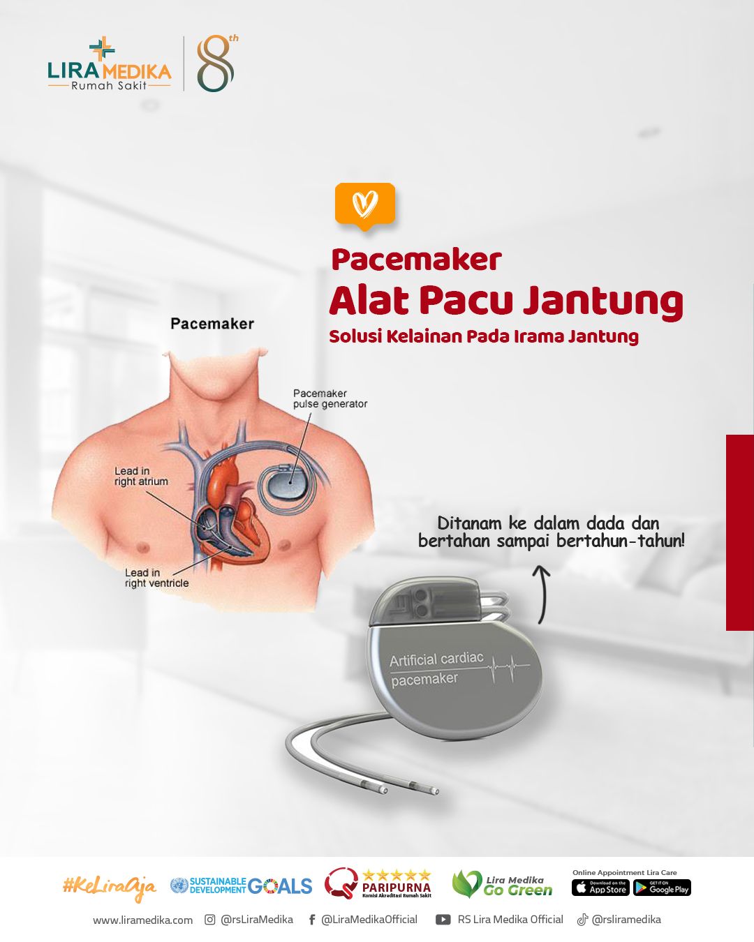 Pacemaker Atau Alat Pacu Jantung, Solusi Kelainan Irama Jant