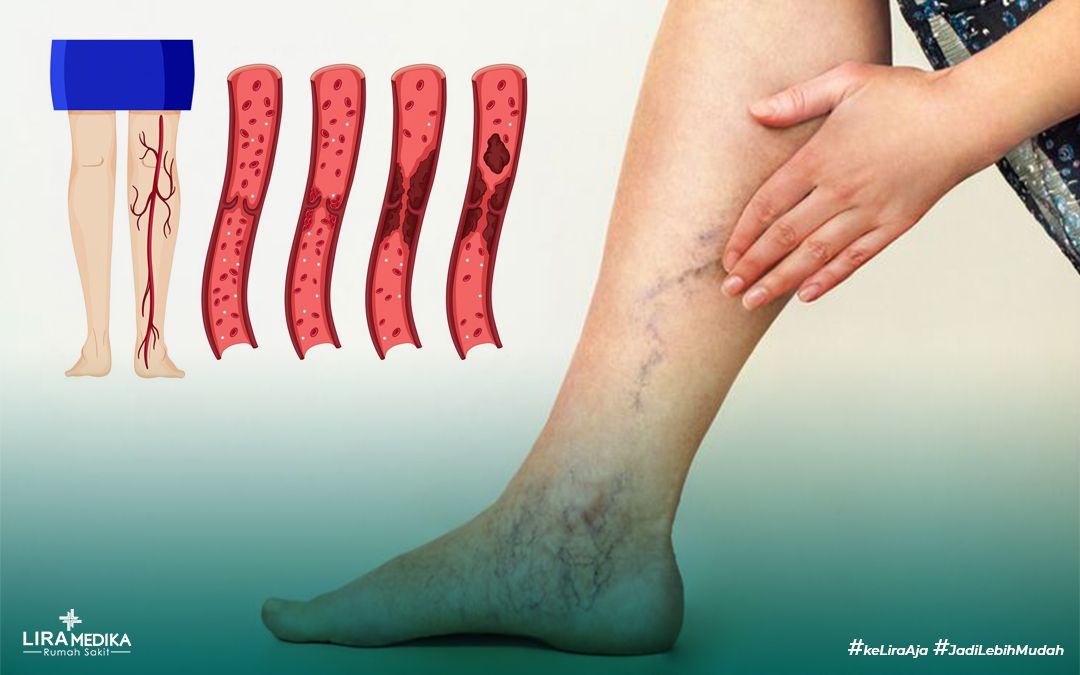 Varises dan Kesehatan Kaki: Mengapa Anda Harus Peduli