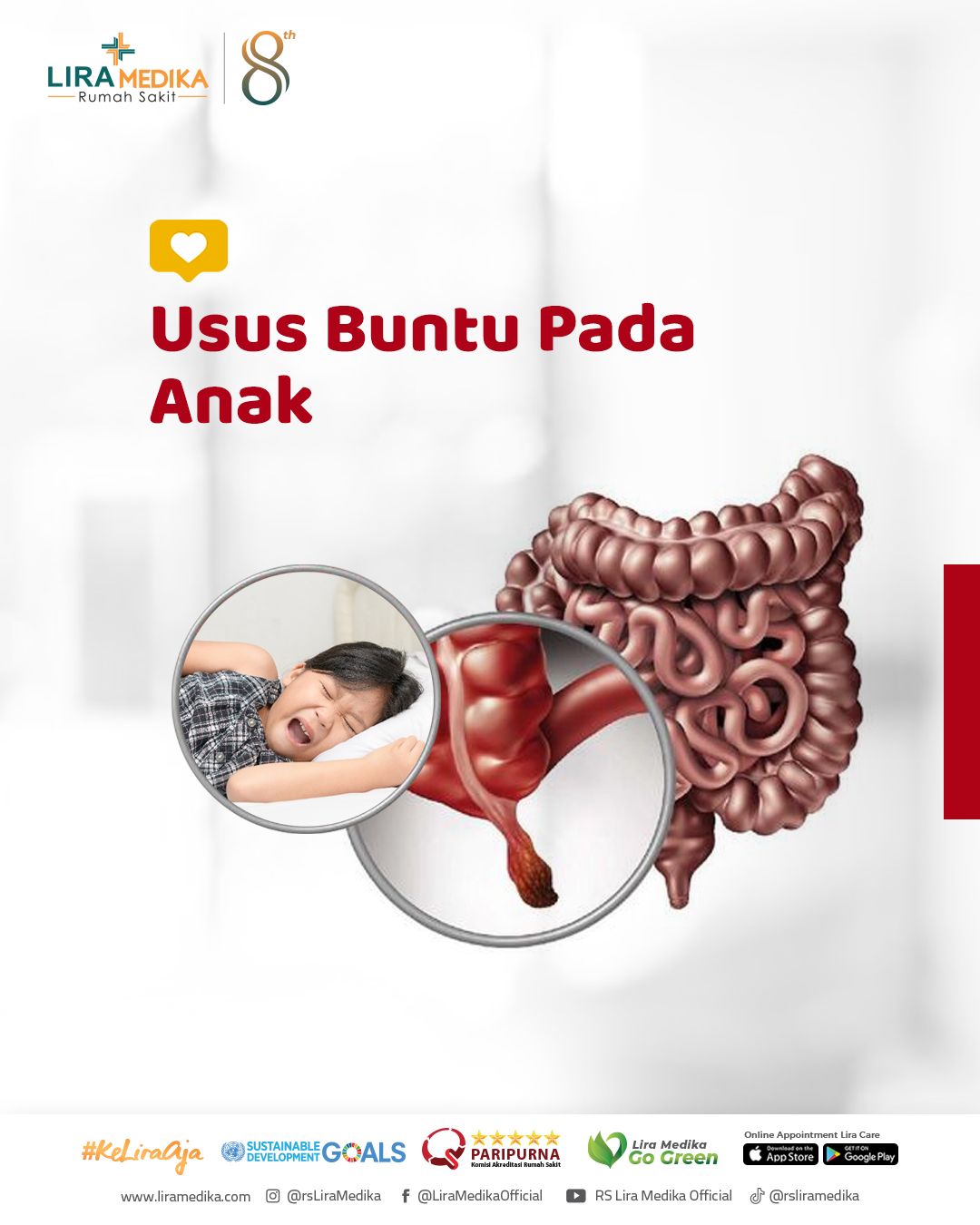 Kenali Usus Buntu Pada Anak