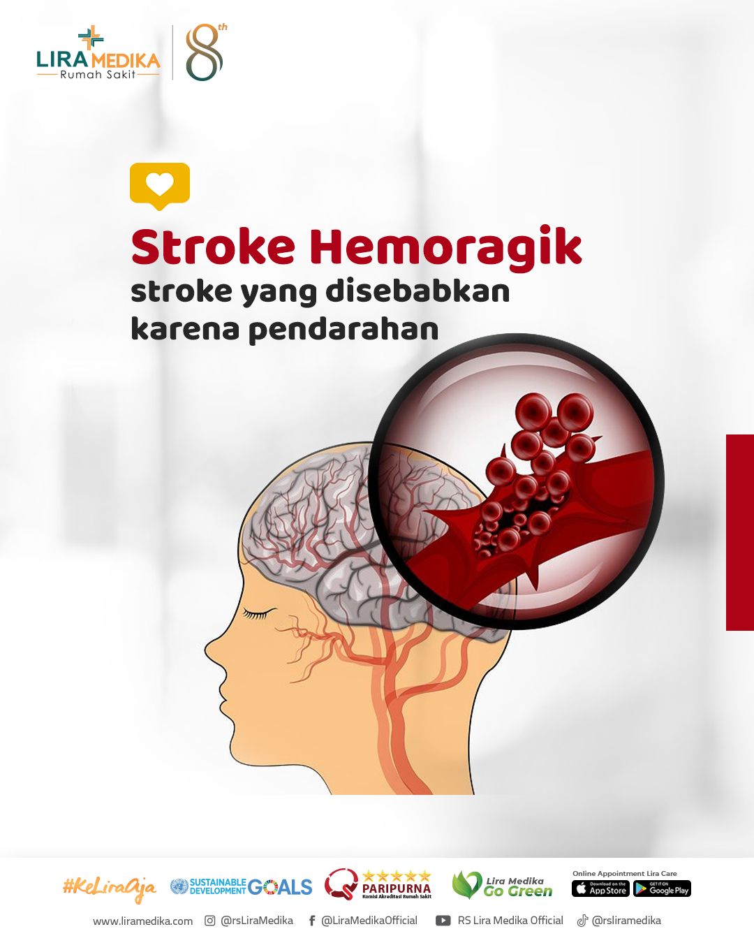 Apa itu Stroke Hemoragik?